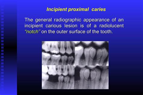 Radiographic Assessment Of Dental Caries Ppt