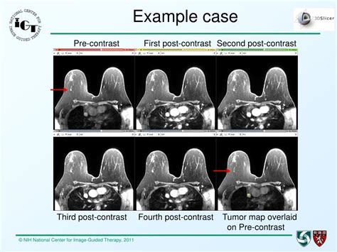 Ppt Tumor Segmentation From Dce Mri With Opencad Powerpoint