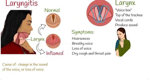 Laryngitis Diagnosis And Treatment