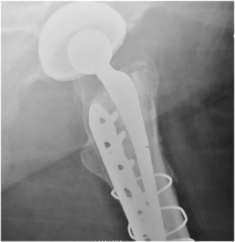 Lateral Radiograph Of The Hip Showing A Stem Fracture Of A Short Exeter