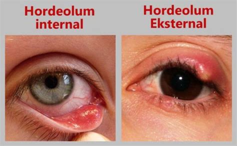 4 Natural Ways To Cure Hordeolum ~ Kesterluc