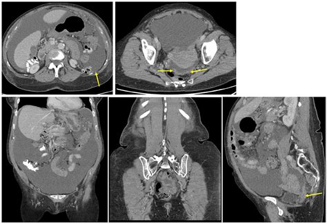 Review Of Imaging Peritoneal Disease And Treatment Colin Mcquade