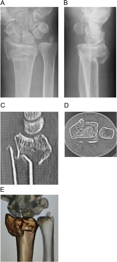 Distal Radius Fracture Complication Checklist And Score Sheet