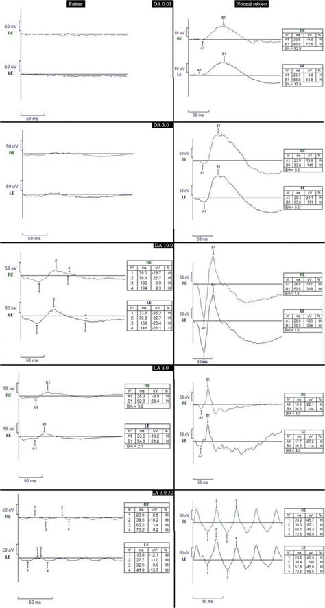 Full Field Electroretinogram Of Both Eyes Including Da Download Scientific Diagram