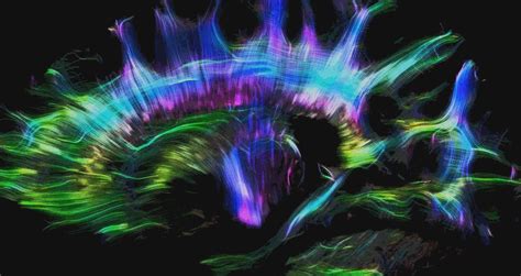 Diffusion Tensor Imaging For Multiple Sclerosis Diagnosis Inside UCR UC Riverside