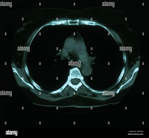 Calcified Lung Adenocarcinoma Ct
