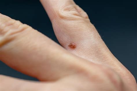 Papiloma En El Dedo Verruga Común Verruca Vulgaris Una Verruga Plana En