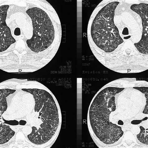 Mycobacterium Xenopi In A Human Immunodeficiency Virus 36 Year Old Download Scientific