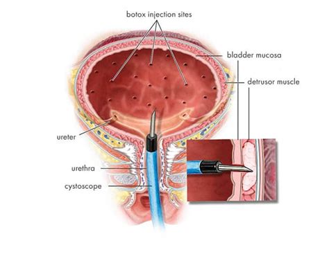 Botox For Overactive Bladder Hfitness