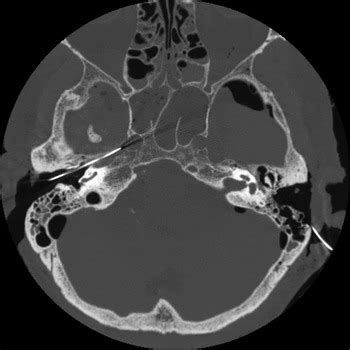 Transtympanic Balloon Dilatation Of Eustachian Tube A Human Cadaver