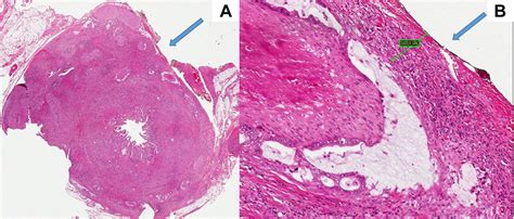 Radial And Longitudinal Margins In Surgery Of Perihilar Cholangiocarcinoma When R1 Definition
