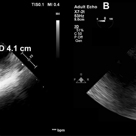 Transesophageal Echocardiography Showing Increased Lvedd Download Scientific Diagram