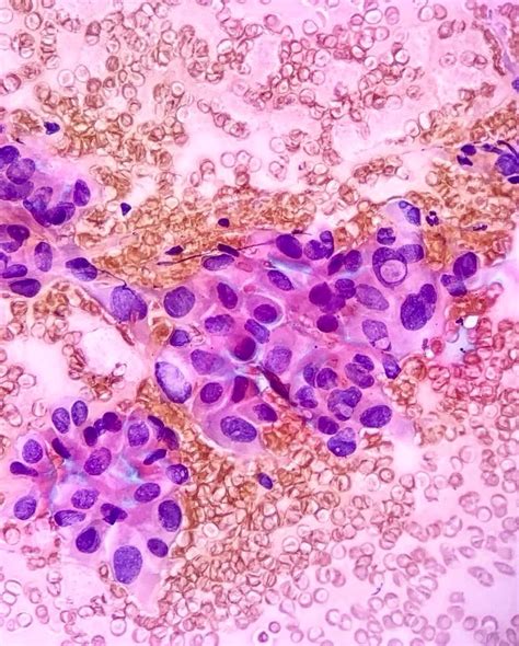 Another Case Of Thyroid Nodule Fna⚡️⚡️ Raheleh Tavakoli 13 Comments