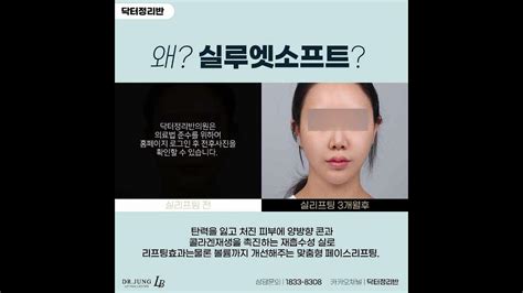 실리프팅 팔자주름없애기 실루엣소프트 실리프팅효과 통증 가격 부작용 후기 닥터정리반 Youtube
