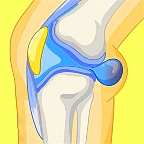 Bakers Cyst The Back Of The Knee Bulge That Reveals More Oregon Regenerative Medicine