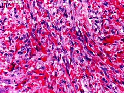 Kaposi Sarcoma Of Lung