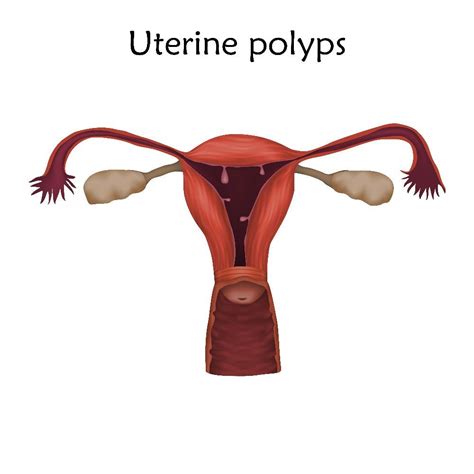 Uterine Polyps Or Endometrial Polyps Are Growths That Become Attached To The Walls Or Lining Of