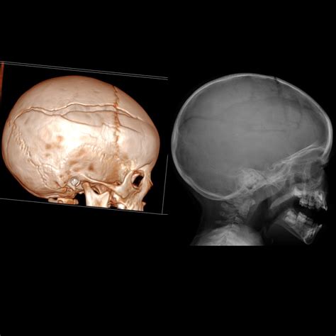 Pediatric Skull Fracture Pediatric Radiology Reference Article