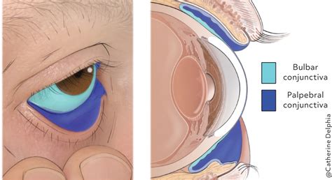 Conjunctivitis Diagnosis And Management Aafp
