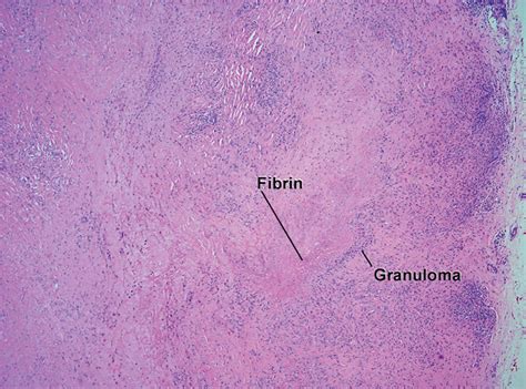 Granulomatous And Histiocytic Diseases Clinical Tree