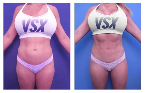 Tummy Tuck With Abdominal Etching Cosmetic Surgery Tips