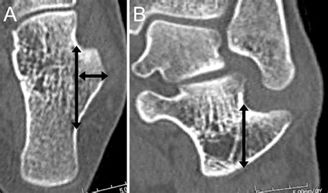 The Width And Length Of The Hypertrophied Peroneal Tubercle Are 11 Mm Download Scientific