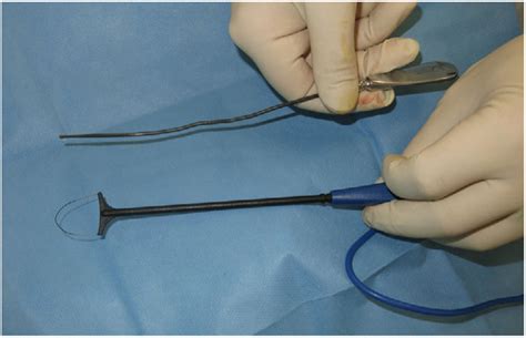 Translated Article Use Of Loop Diathermy Conization For Deroofing
