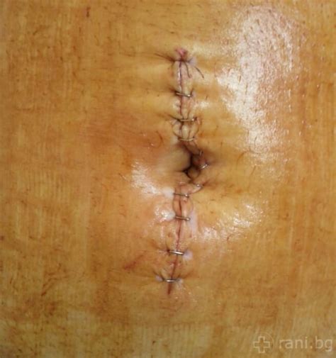 Превръзки на хирургични рани Сваляне на конци По домовете