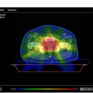 Ontreatment QA Of The Reference Plan A TPS Dose Distribution B Download Scientific