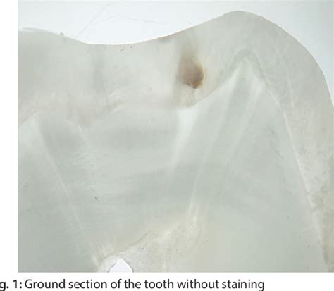 Figure 1 From Staining The Ground Section Of The Tooth Using An