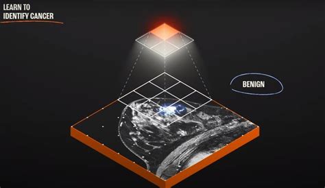 Transforming Breast Cancer Detection With Ai