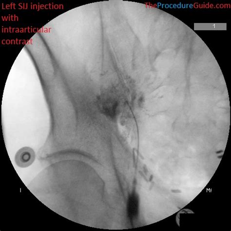 Fluoroscopic Guided Sacroiliac Sij Joint Injection Technique And Overview The Procedure Guide