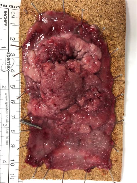 Esd Specimen 1 Describe The Morphology Of This Polyp 2 Site Of