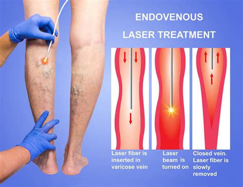 Advanced Vein Treatments In Mumbai Varicose Veins Mumbai
