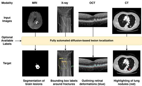 [논문 리뷰] Denoising Diffusion Models For Anomaly Localization In Medical