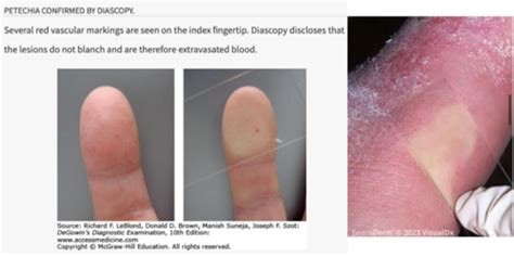 Dermatologic Terms And Approach To Patient Flashcards Quizlet