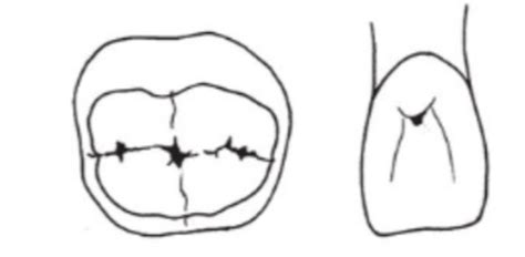 Gv Blacks Classification Of Caries Flashcards Quizlet