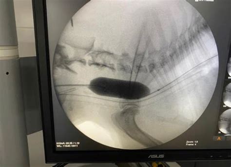 Estenosis Esofàgica Memvet