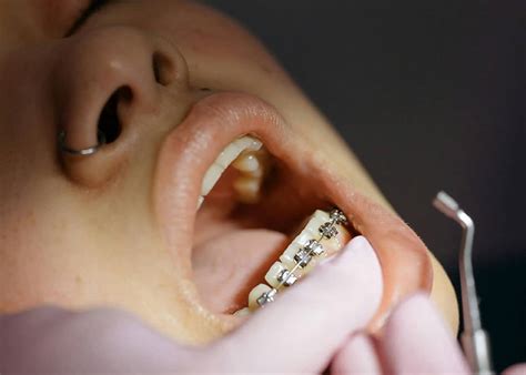 What Causes Yellow Bruising After Wisdom Teeth Removal Oral Facial