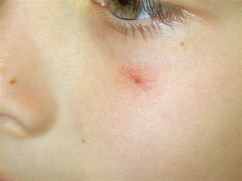 Spider Angioma Symptoms Causes Pictures Treatment 2018 Updated