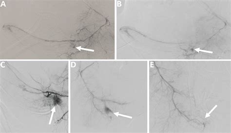Selective Penile Arterial Embolization Preserves Long Term Erectile