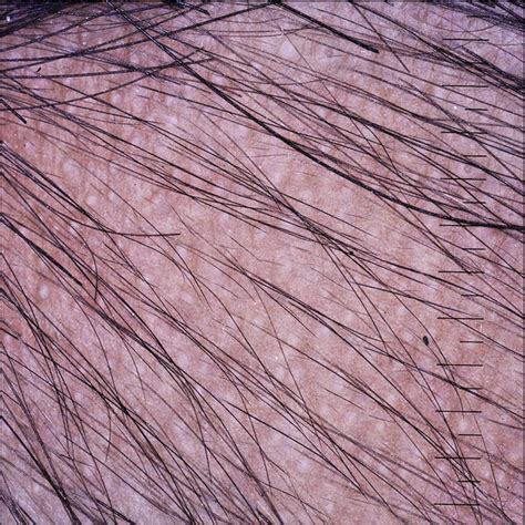 Congenital Triangular Alopecia Journal Of Skin And Sexually Transmitted Diseases