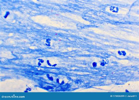 Mycobacterium Tuberculosis Positive In Sputum Smear Stock Image 173026399