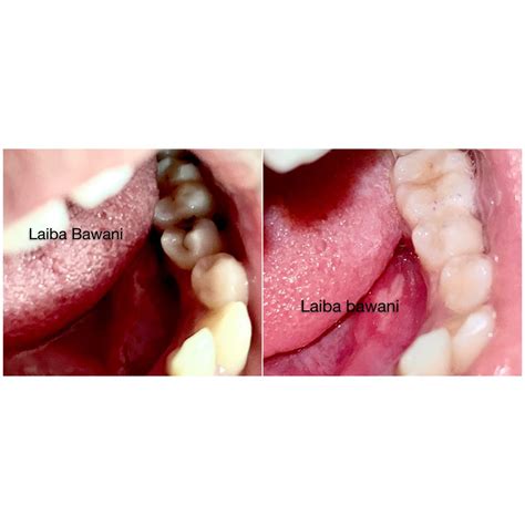 Highly Infected Second Premolar Affecting Proximal Walls Of Adjacent Molar Too Canal Orifice