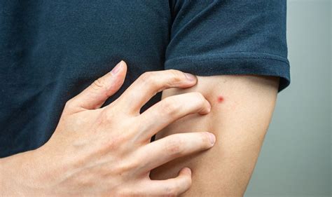 Im A Pharmacist Here Are Three Things You Should Do If You Get Bitten By Bed Bugs Express Im A Pharmacist Here Are Three Things You Should Do If You Get Bitten By Bed Bugs Express