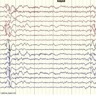 EEG Of The Patient Demonstrating Epileptic Activity At Admission Download Scientific Diagram