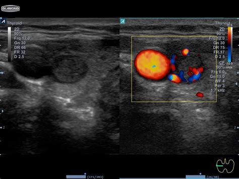 1 갑상선초음파 김호중이비인후과