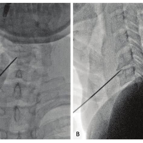 Cervical Discectomy Procedure On The C5 C6 Disc Antero Posterior View Download Scientific