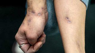 Xylazine What To Know About The Flesh Eating ‘zombie Drug Spreading