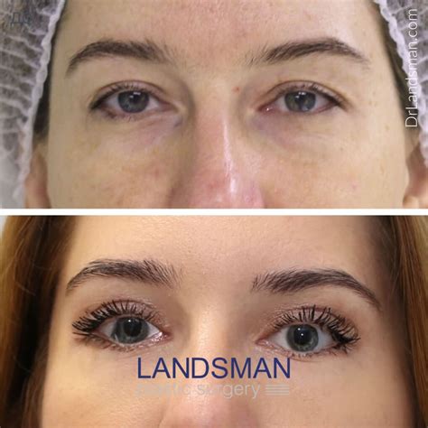 Landsman Blepharoplasty Before After 👀 Book Your Blepharoplasty Consultation With Dr Landsman